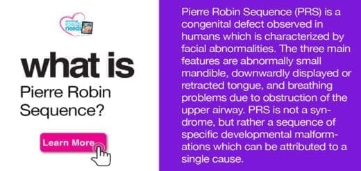 What is Pierre Robin Sequence? – Parenting Special Needs Magazine